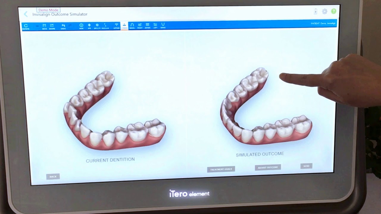Invisalign 3D Simulator - YouTube