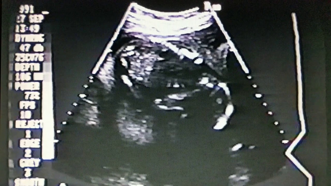 1991 Bruce Fox Sept 27 1991 Ultra Sound future son of James and Aimee ...