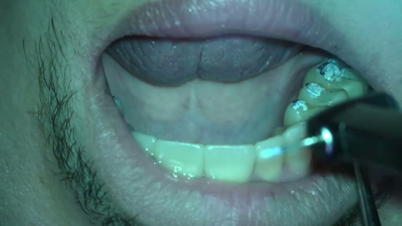 Composite Injection Technique - YouTube