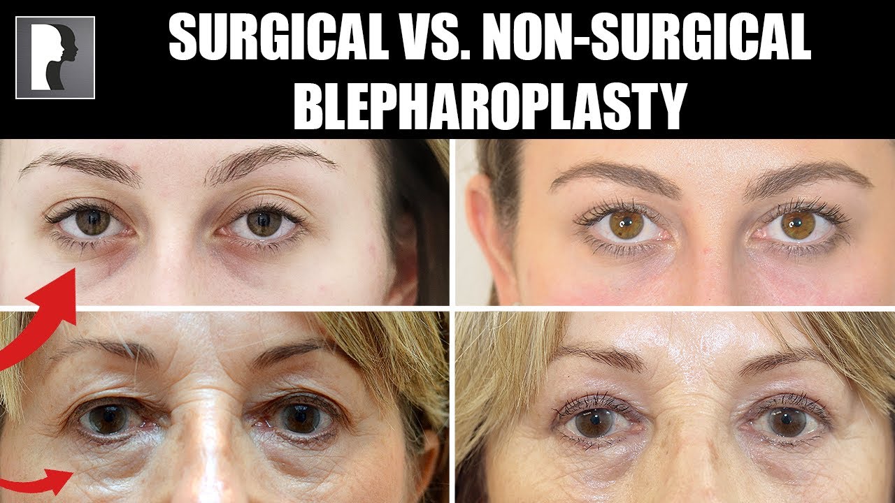 Surgical Vs. Non Surgical Blepharoplasty - What are the risks? - YouTube