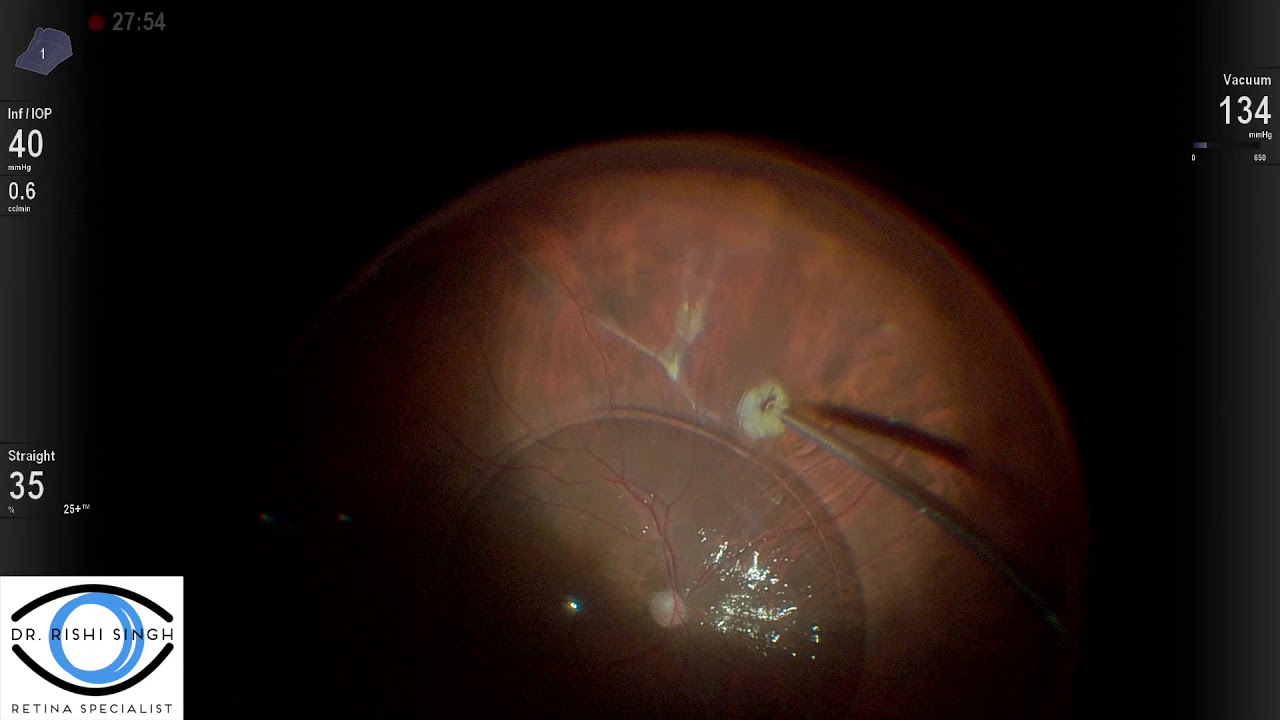 Pimple Popping for the retina specialist - YouTube