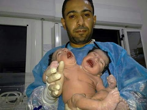 Humans born with 2 heads. - YouTube