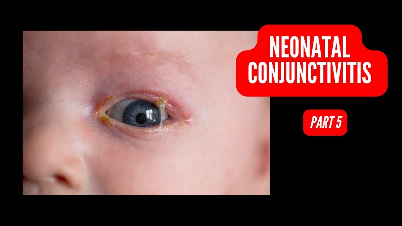 Neonatal Conjunctivitis || Conjunctiva part 5 #mbbs #medical #100k ...