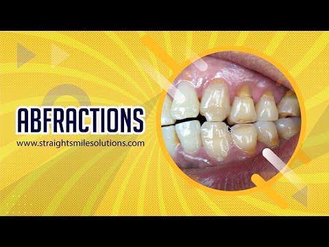 Abfractions https://www.straightsmilesolutions.com/ - YouTube