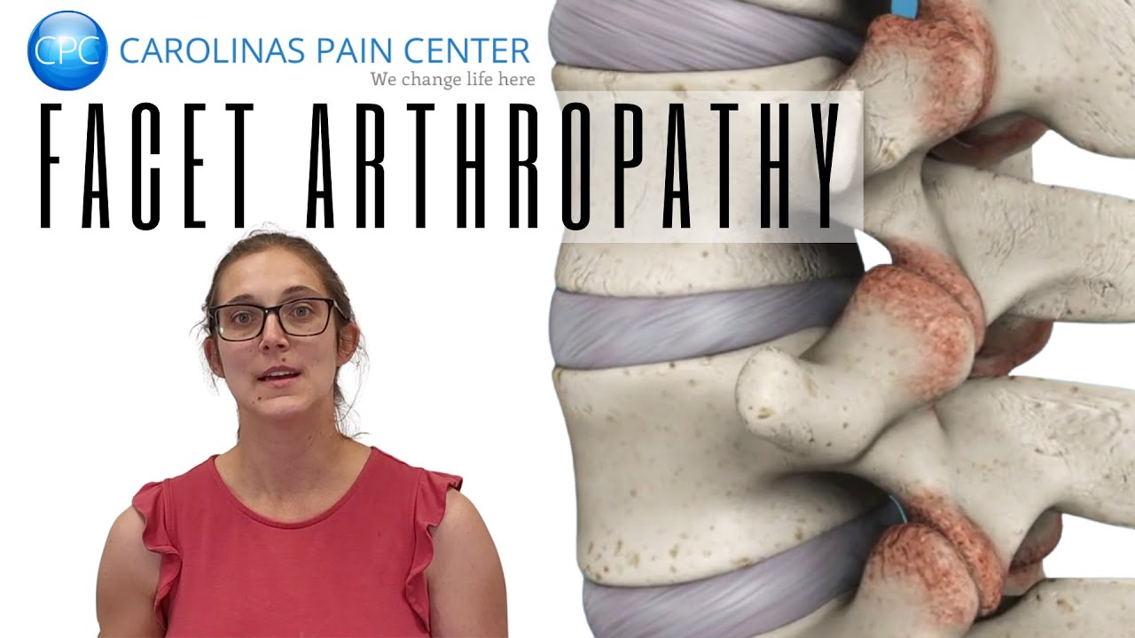 Natalie Explains Facet Arthropathy - YouTube