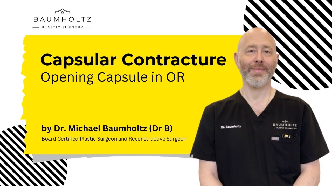 Capsular Contracture - Opening Capsule in OR - YouTube