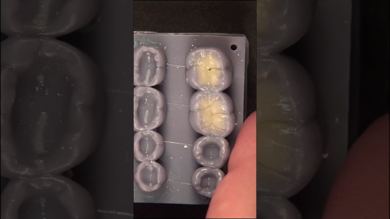 Dental motivation. Direct composite restoration. Restoration teeth ...