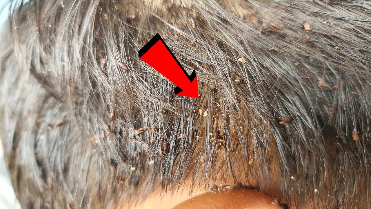 We help picking out these Giant Lice from boy head - Lice Comb - YouTube