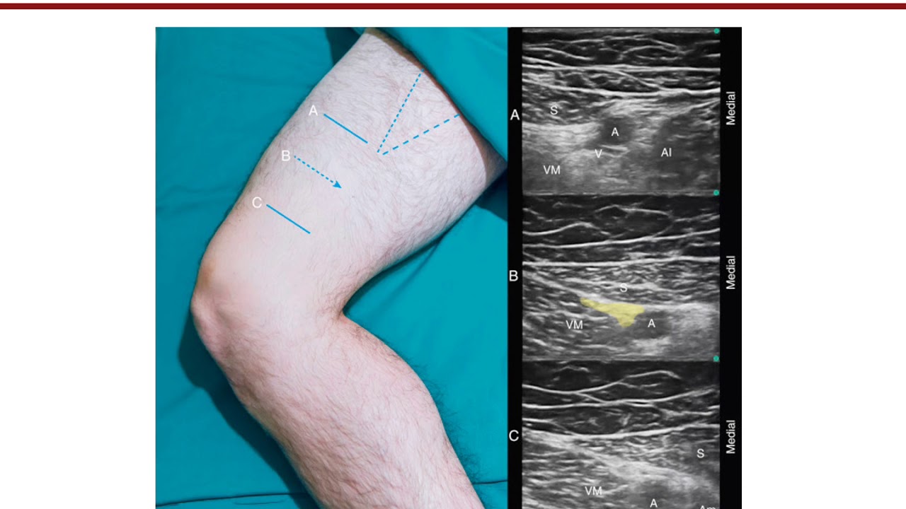 Adductor Canal Nerve Block.mp4 - YouTube