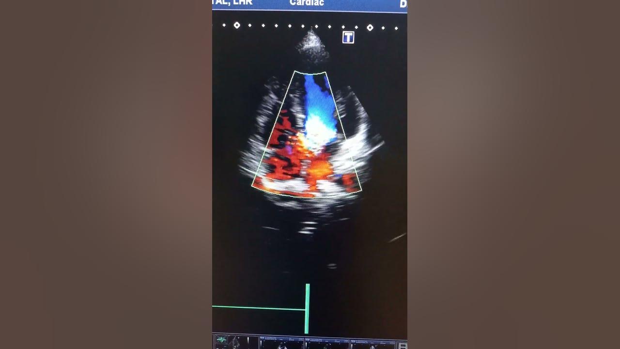 Subaortic Membraneecho Fcps Echorouk Lv Echo Board Review Youtube