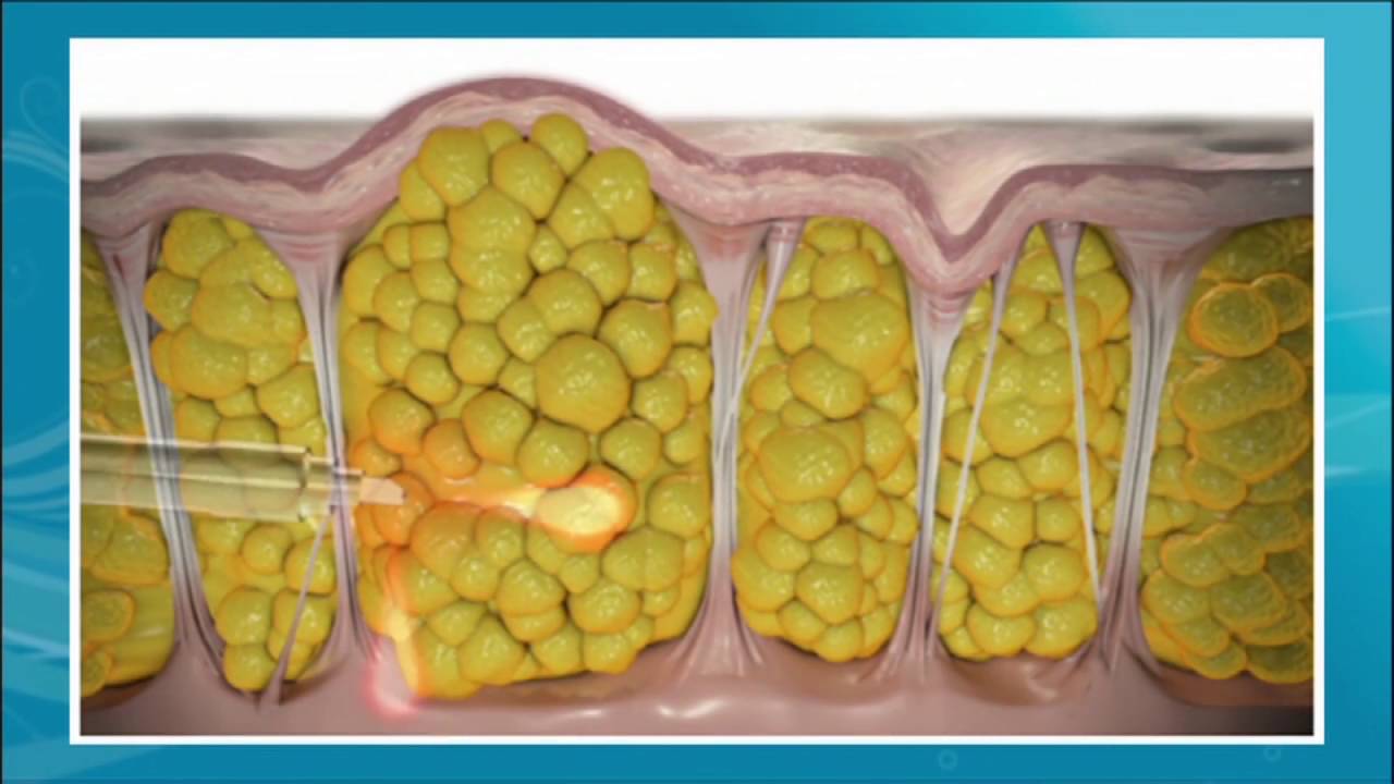 CELLULAZE™ LASER CELLULITE TREATMENT at Women First GYN, Dr. Margie ...