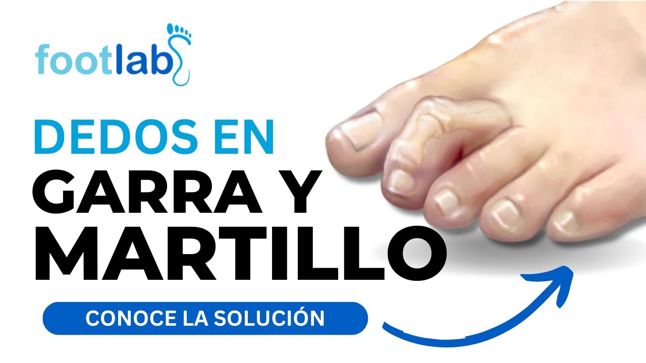 🦶Dedo en garra y martillo: Causas, síntomas y soluciones definitivas🤔 ...
