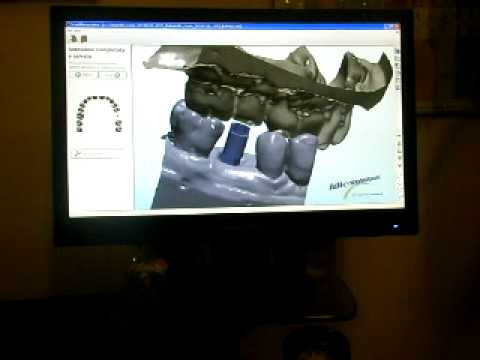 Modellazione moncone dentale - YouTube