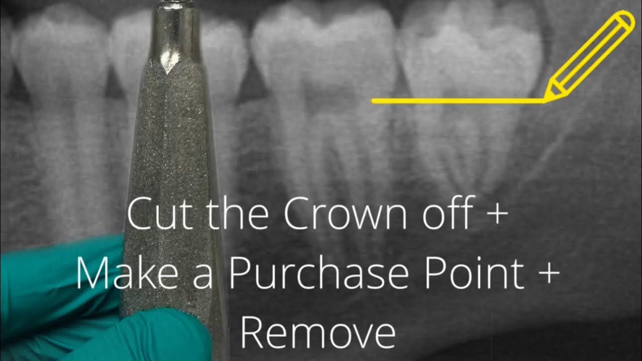 Black + White Version: Cut the Crown off to Extract this Tooth - YouTube