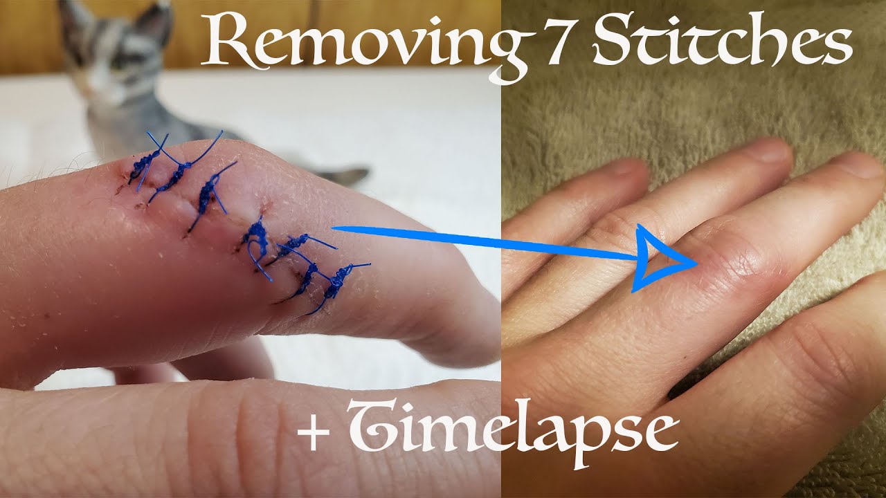 Removing Stitches From Finger & Time-lapse Healing Process - YouTube