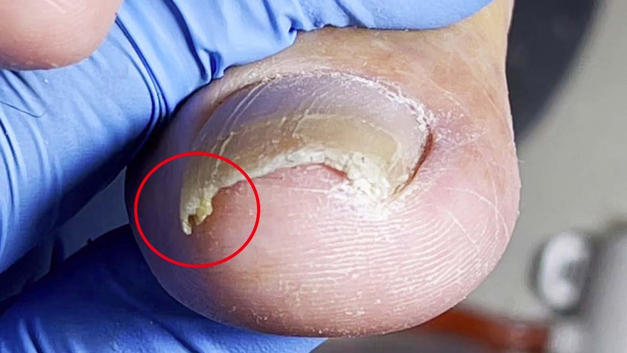 Pedicure tutorial: super roll nail trim! - YouTube