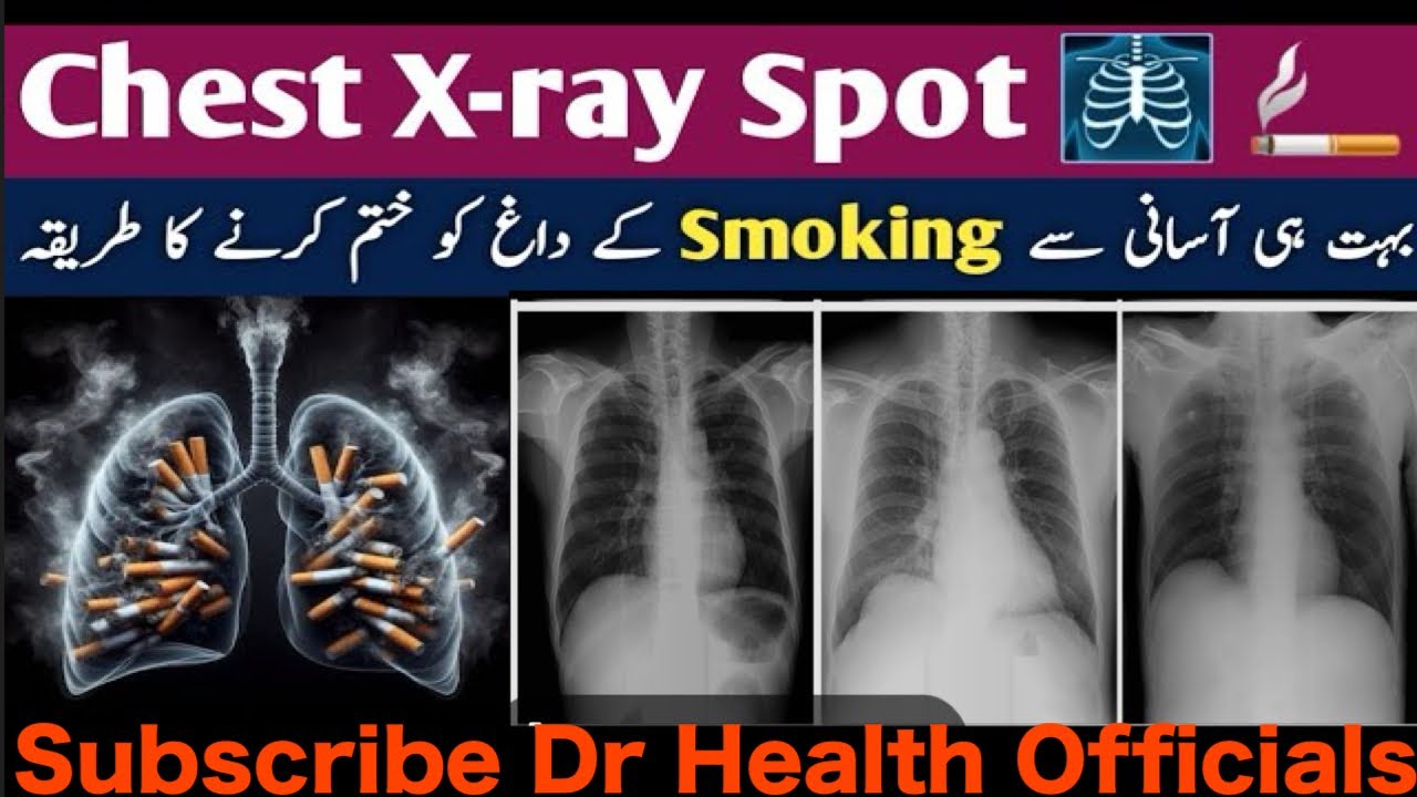 Worlds Aids day Chest X-ray involves Aids Dr Health Officials - YouTube