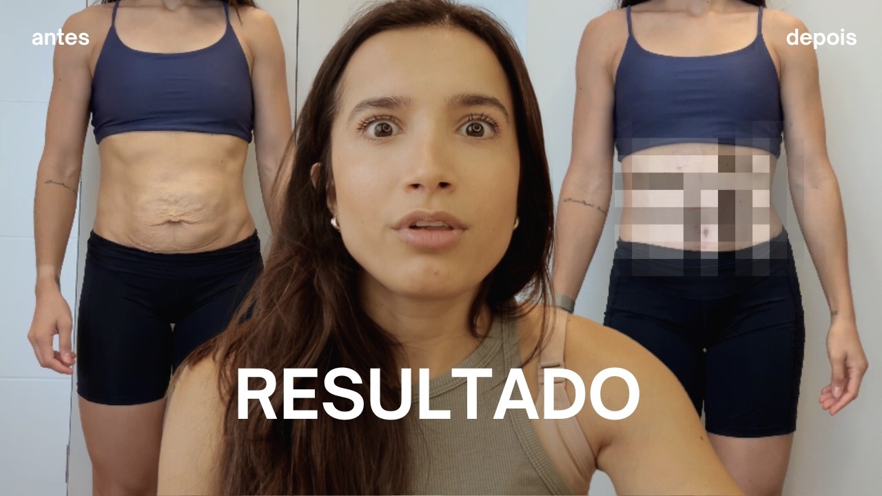 RESULTADO da BARRIGA pós 7 dias de ABDOMINOPLASTIA, recuperação e papo ...