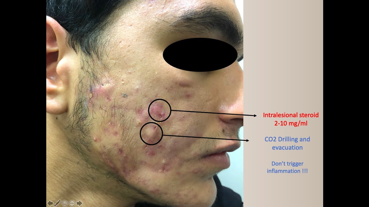 CYSTIC ACNE MANAGEMENT - YouTube