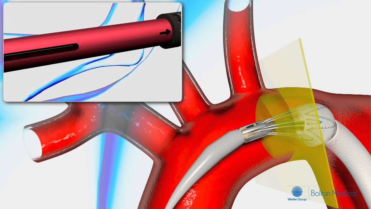 HD Deployment of Relay Plus Stent Graft - YouTube