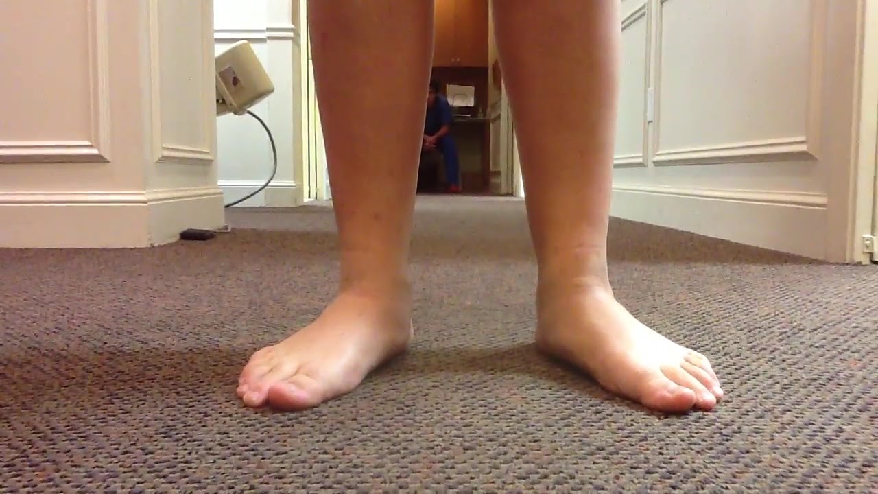Gait analysis of pediatric flatfoot prior to surgical correction SFISM ...