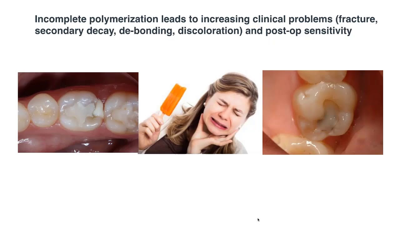 Dental Treatment: Mastering Light Curing Dec 11, 2019 - YouTube