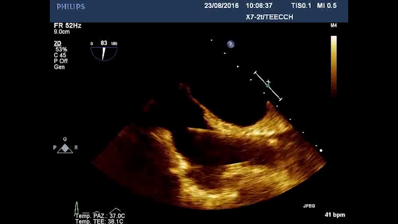 Asvide: TEE Midesophageal bicaval view. Wire in the correct position ...