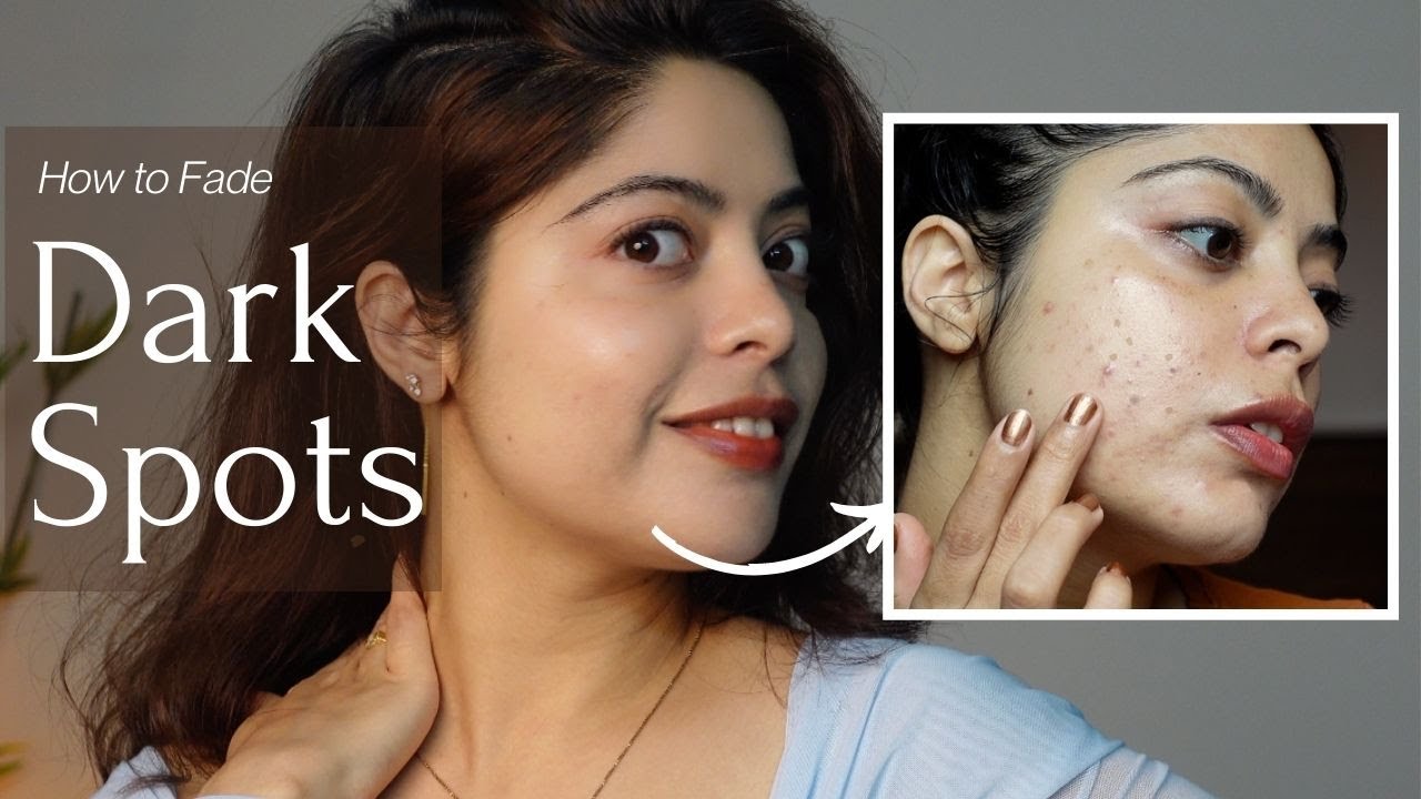 How to clear Acne Spots / Dark Spots Fast! 💫 for Boys also💡 - YouTube