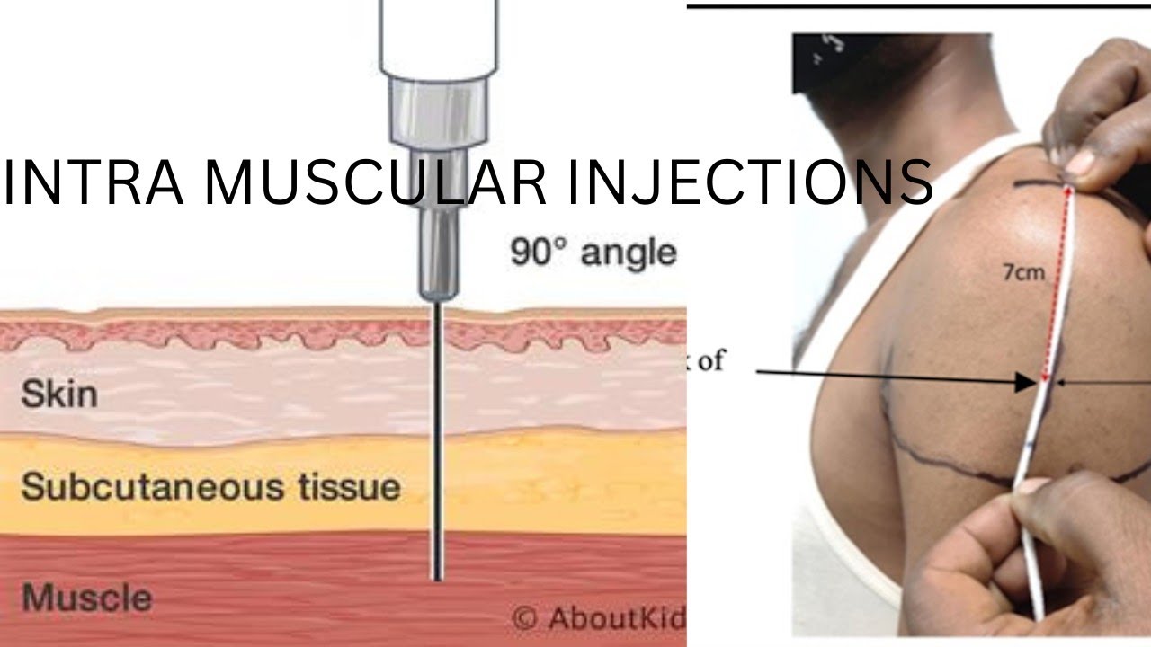 Intramuscular Injection Technique Intramuscular Injection Technique