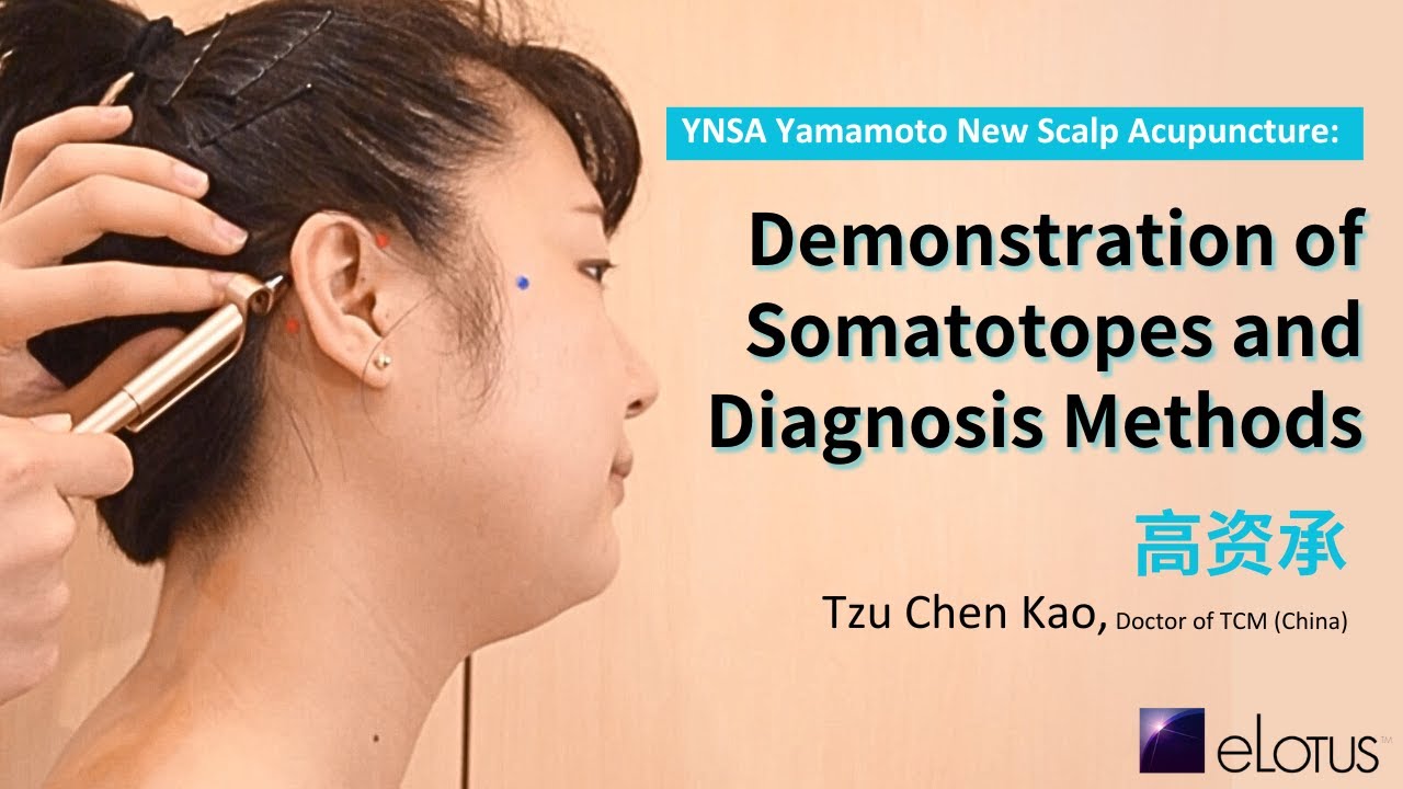 YNSA Yamamoto New Scalp Acupuncture: Demonstration of Somatotopes and ...
