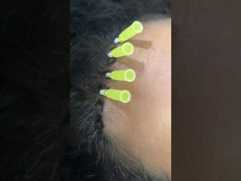 Scalp threads for thinning hair improvement - YouTube
