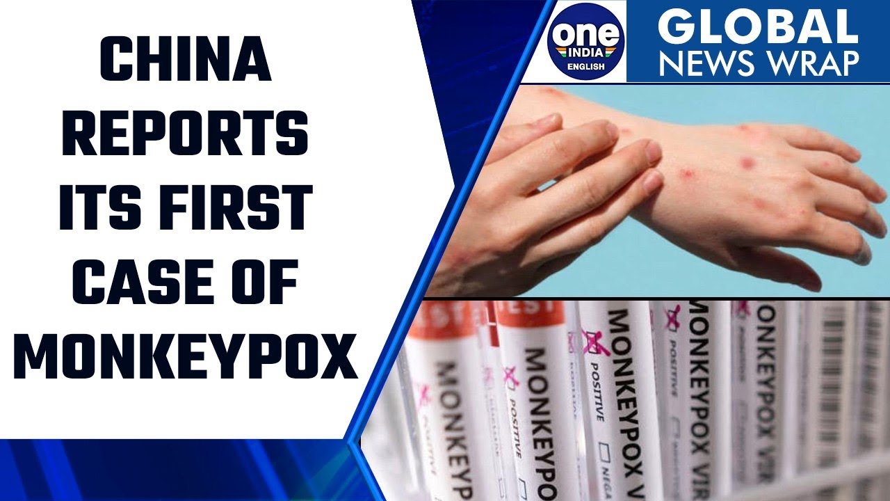 China reports first imported Monkeypox case in the mainland | Oneindia ...