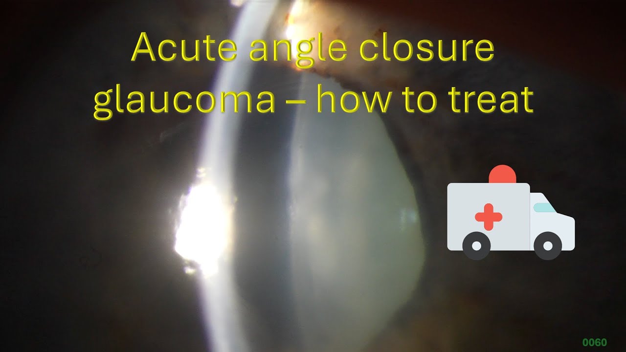0060: Acute angle closure glaucoma - how to treat? - YouTube