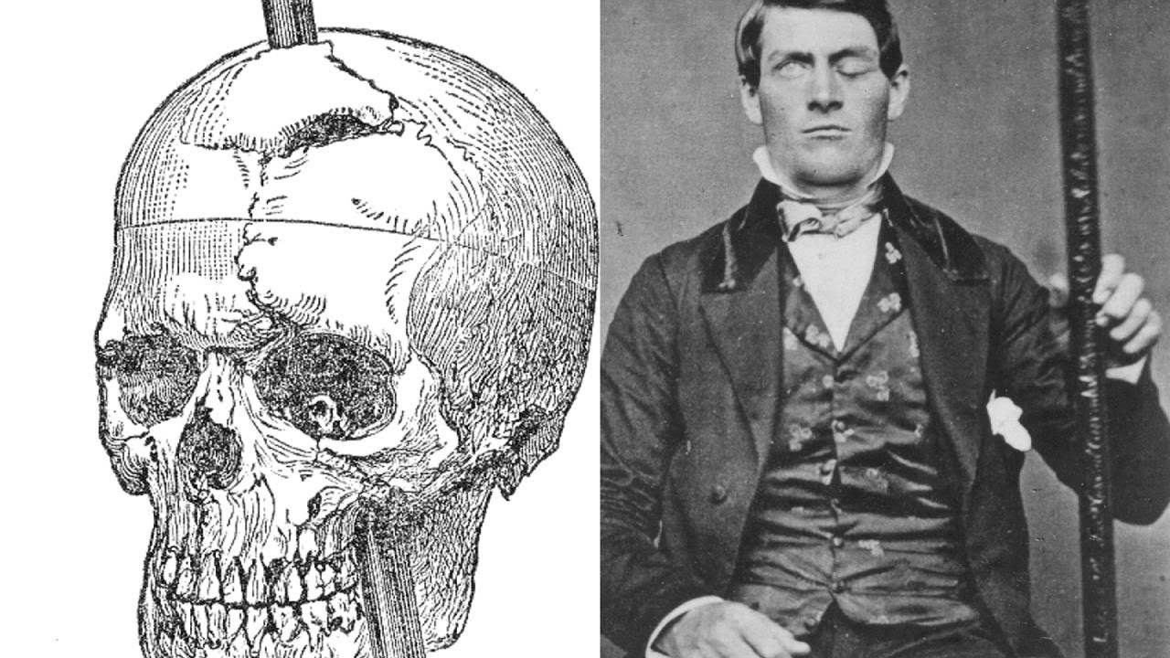He Survived an Iron Rod Through His Brain — The Weird Story of Phineas ...