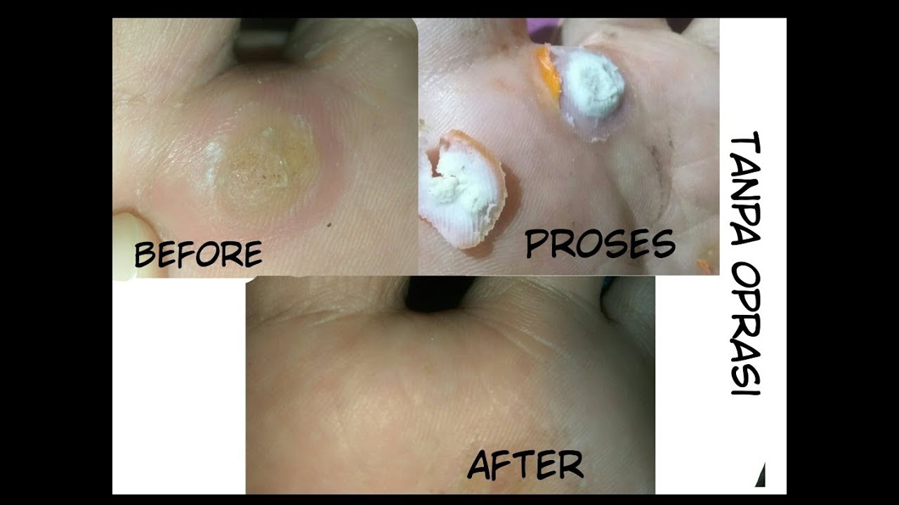 Cara ampuh menghilangkan mata ikan tanpa oprasi cara pakai plaster mata ikan - YouTube
