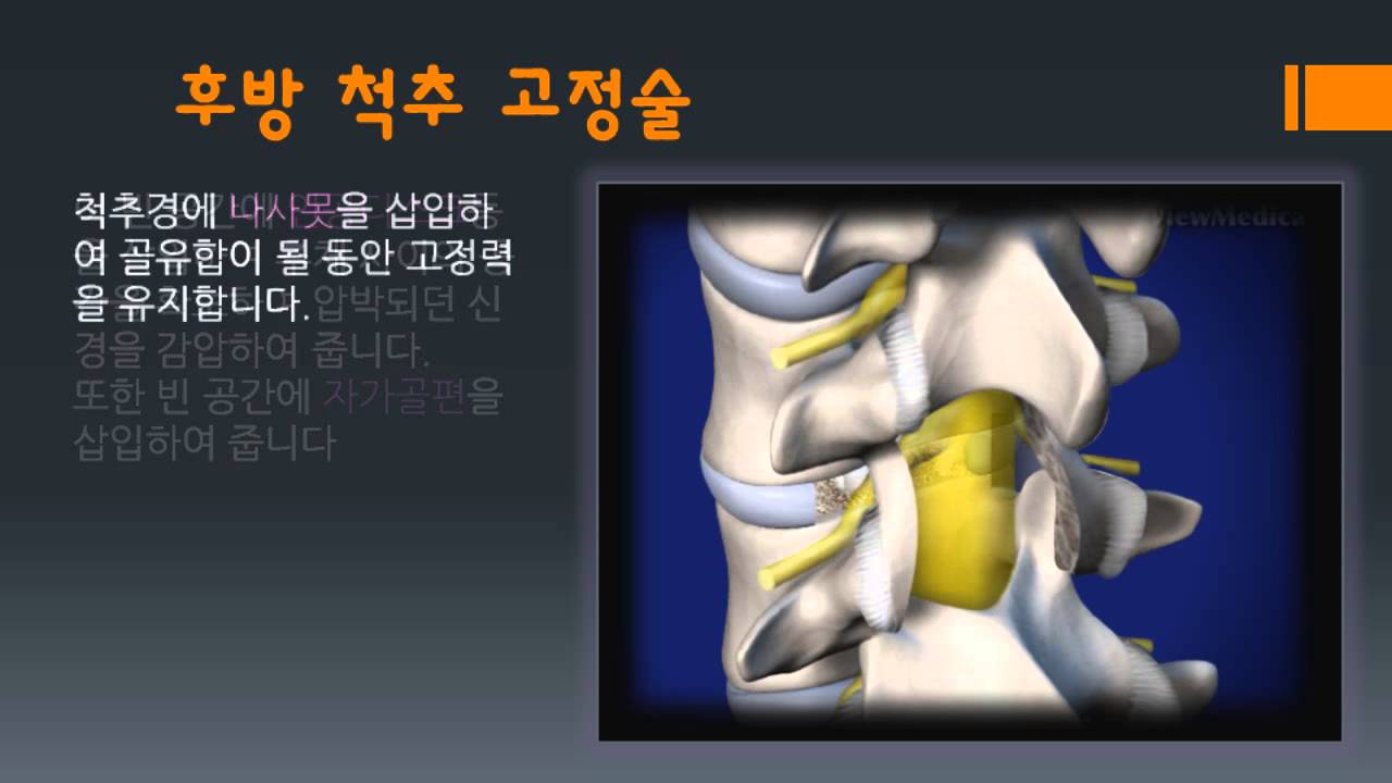 [영상제작] 척추, 관절병원 PLIF Posterior Lumbar Interbody Fusion - YouTube