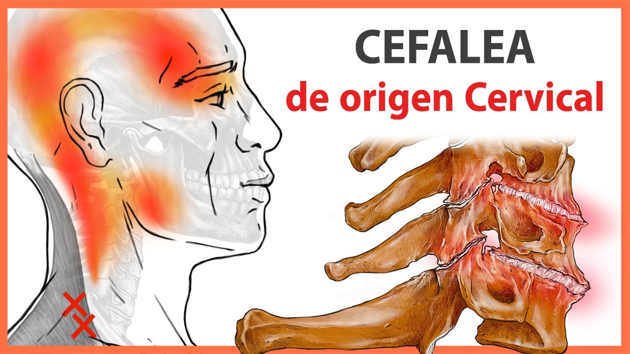 🛑 CLAVES de la CEFALEA 👉 Dolor de Cabeza de ORIGEN CERVICAL | ¿Qué es y ...