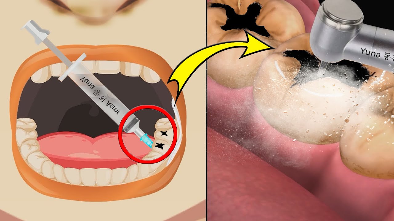 ASMR Animation | 치과 충치제거 | Caries removal animation | Dental care - YouTube