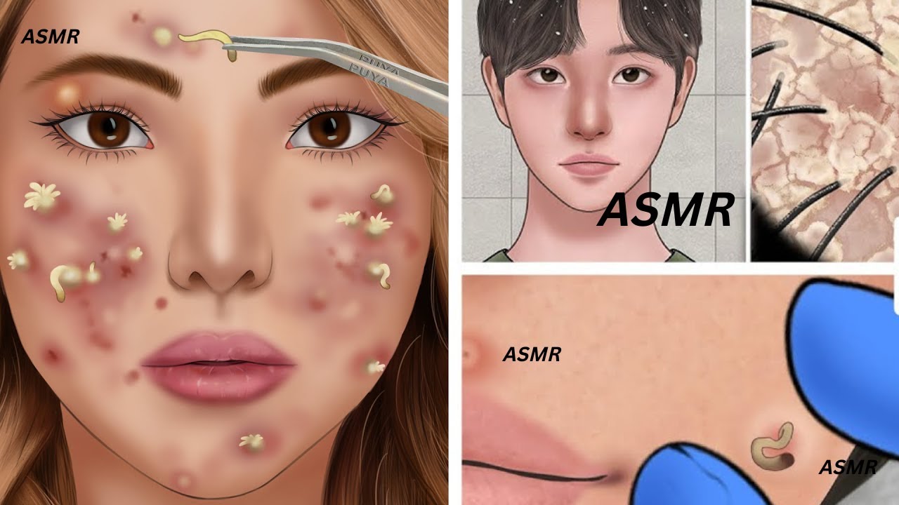 ASMR Removal acne and head lice from the nape at hairline | seborheic ...