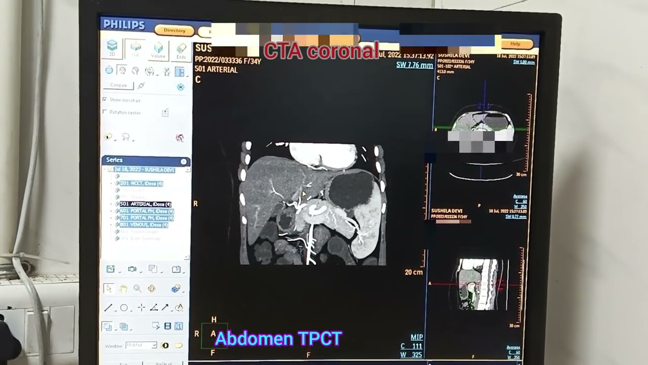 Triple phase abdomen | CT scan abdomen angiography | CTA #ct_scan # ...