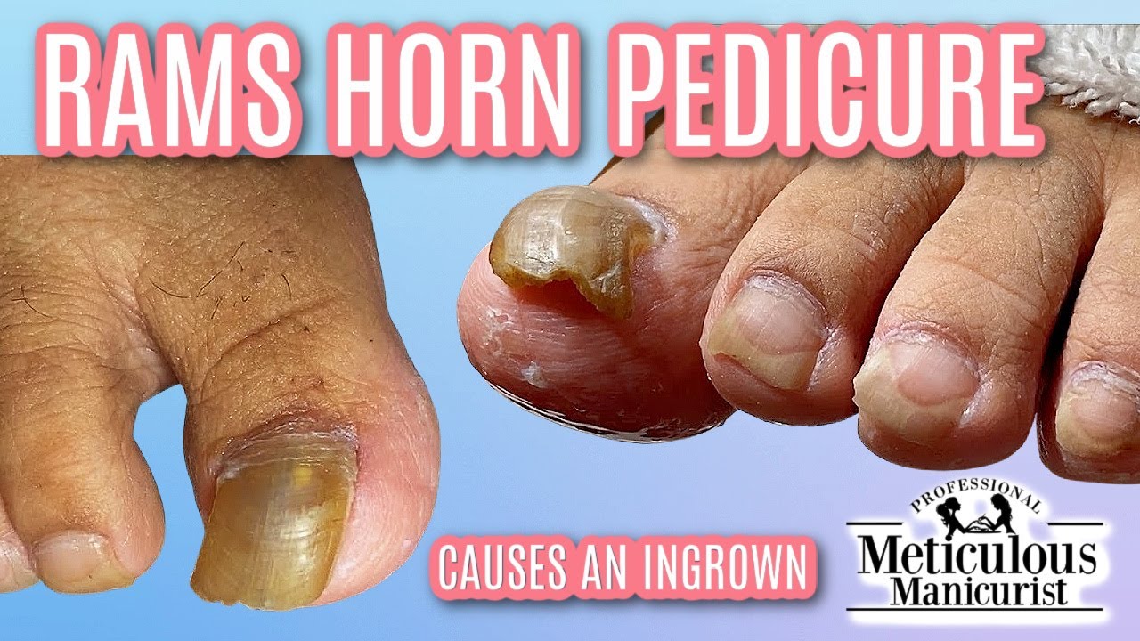RAM'S HORN TOENAILS CAUSE INGROWN TOENAIL - YouTube