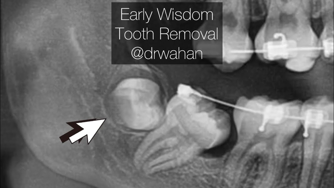 Early Wisdom Tooth Removal @drwahan - YouTube