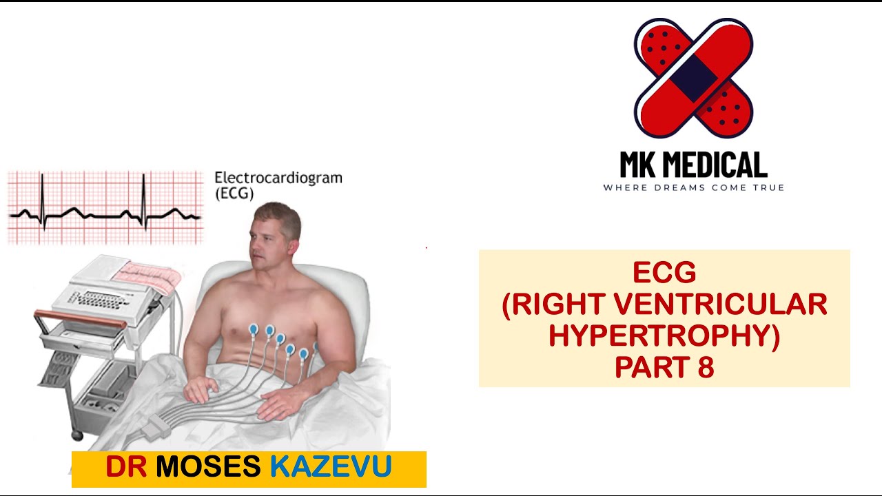 ECG (Right ventricular hypertrophy) Part 8 - YouTube