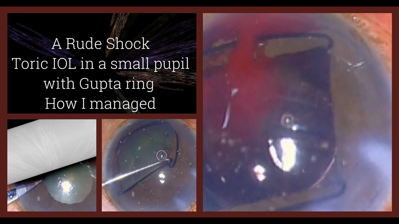 "A Rude Shock" - Toric IOL in a small pupil with the Gupta ring.. How I ...