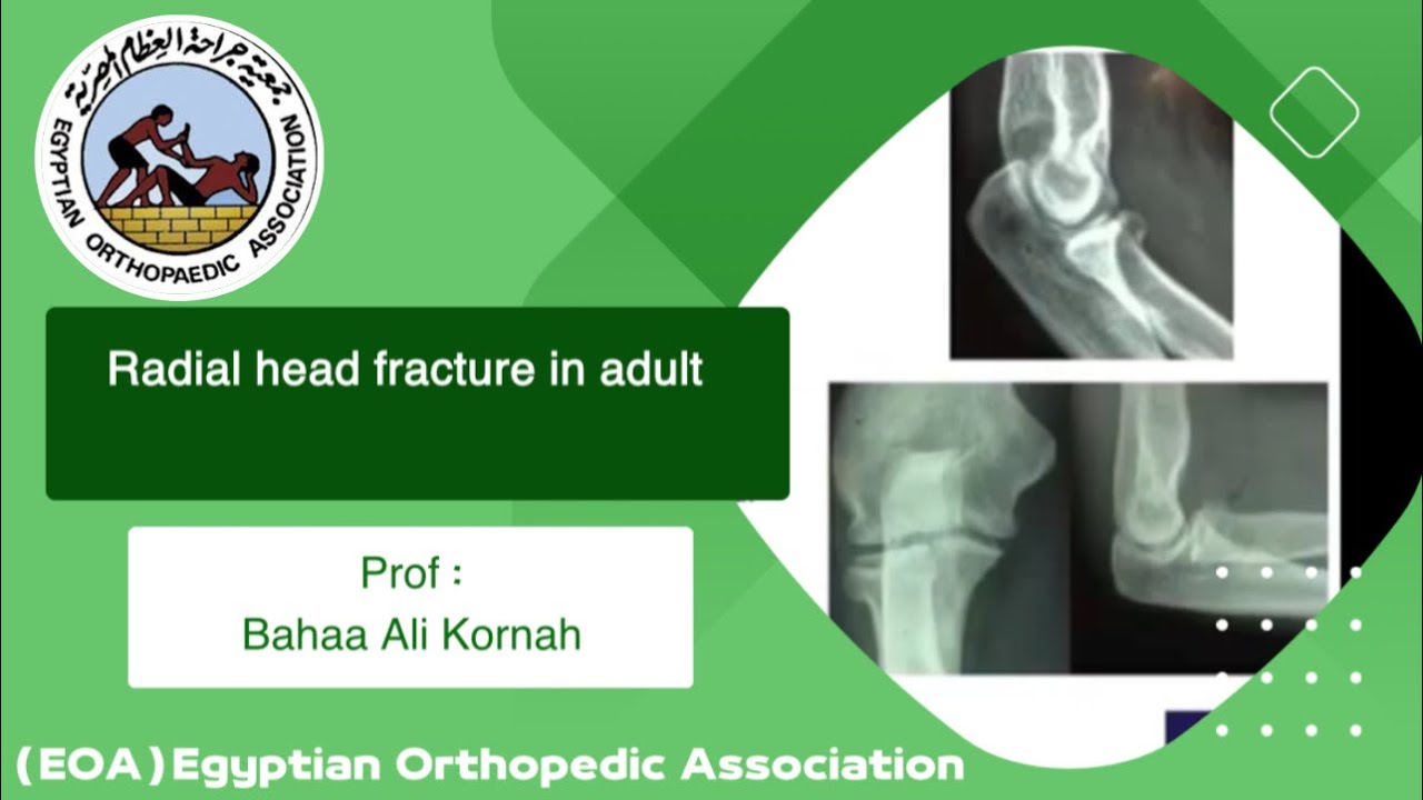 Radial head fracture in adult (Prof . Bahaa Ali Kornah ) - YouTube