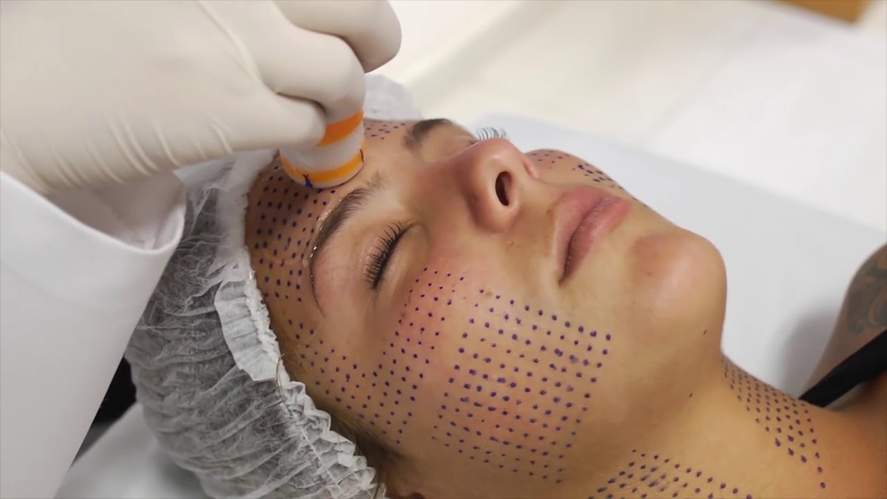 Ultrafocus - Equipamento de Ultrassom Focalizado e Microfocado HTM ...