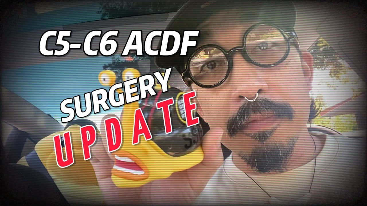 ACDF C5-C6 ANTERIOR CERVICAL DISCECTOMY FUSION SURGERY UPDATE 2024 ...
