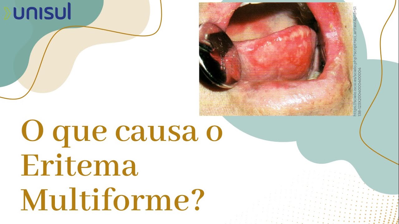 O que causa o Eritema Multiforme? - YouTube