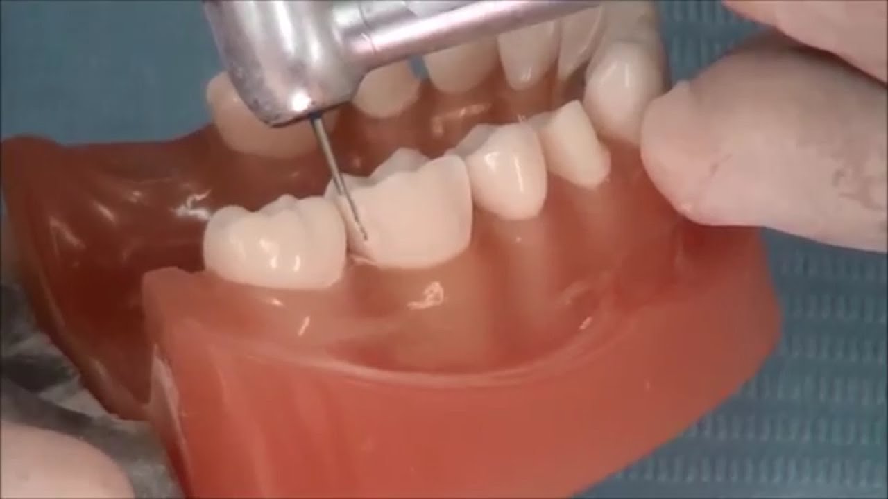 How to prepare a Fixed Bridge - YouTube