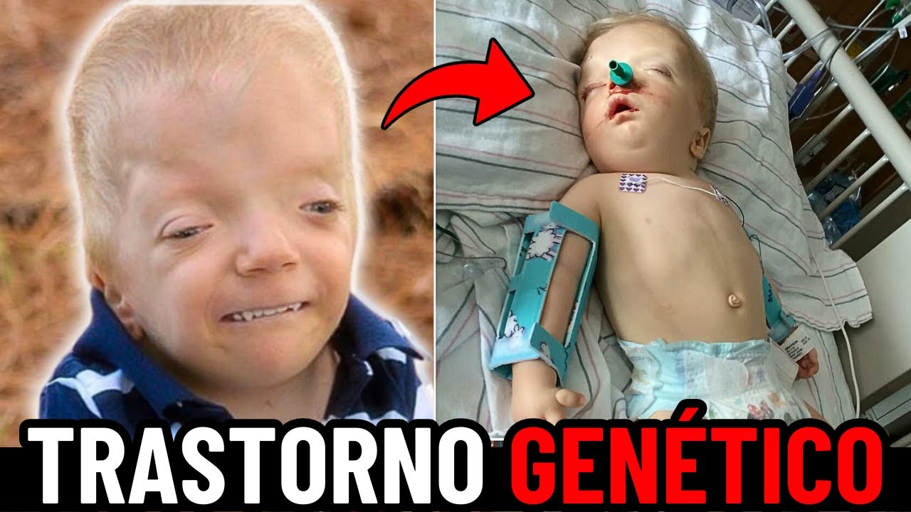 El Síndrome De Grayson (El UNICO CASO CONOCIDO en la Historia Humana ...